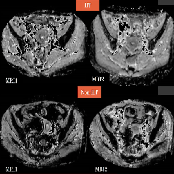 Intravoxel Incoherent Motion MRI Assessment of Chemoradiation Induced ...